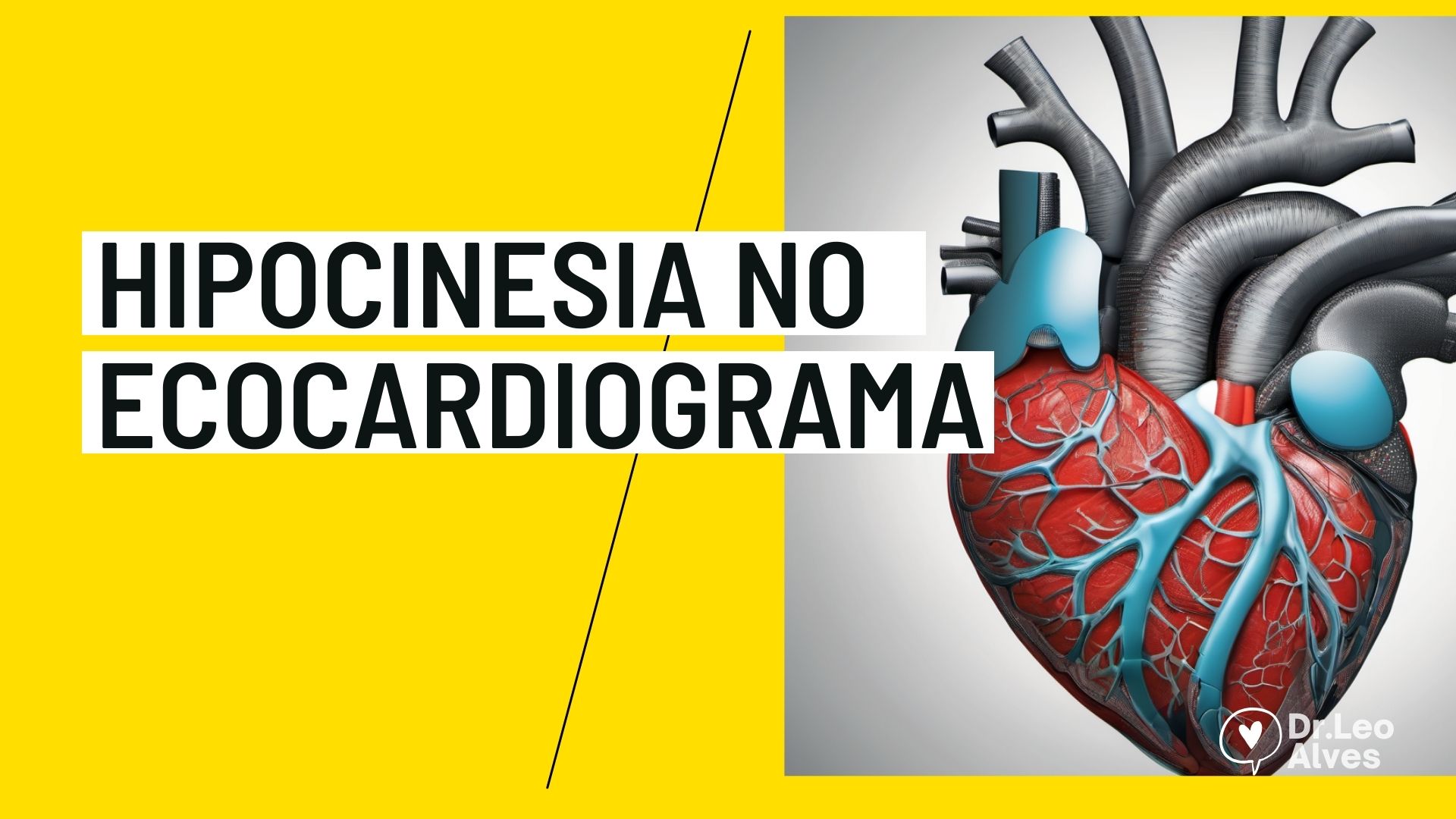 Hipocinesia difusa no Ecocardiograma [2024] - Dr. Leonardo Alves ...